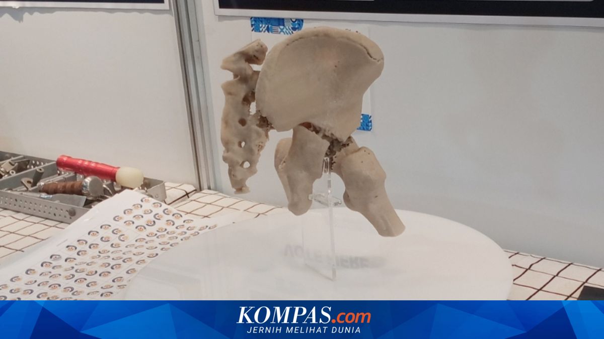 Dokter di Malang Dorong Penerapan Teknologi 3D Printing untuk Operasi ...
