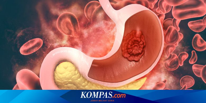 Penyakit Kanker Perut - Gejala, Penyebab, Pengobatan - Kompas.com