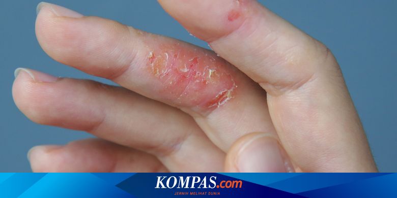 Penyakit Dishidrosis - Gejala, Penyebab, Pengobatan - Kompas.com