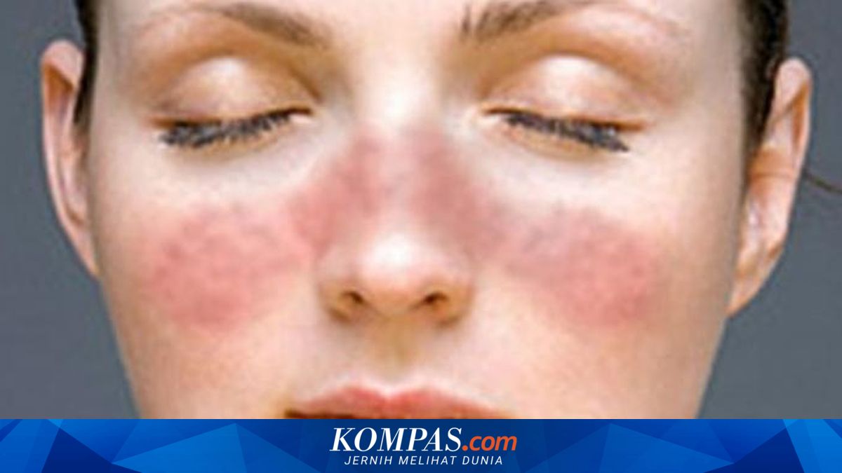 Tanda-tanda Penyakit Lupus Kulit yang Perlu Diperhatikan