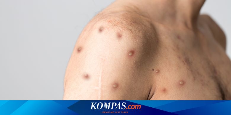 Ini Alasan Mengapa Orang Kelahiran 1980 ke Bawah Terproteksi dari Cacar ...
