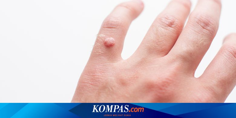 Penyakit Kutil - Gejala, Penyebab, Pengobatan - Kompas.com
