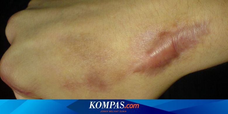 Penyakit Keloid - Gejala, Penyebab, Pengobatan - Kompas.com