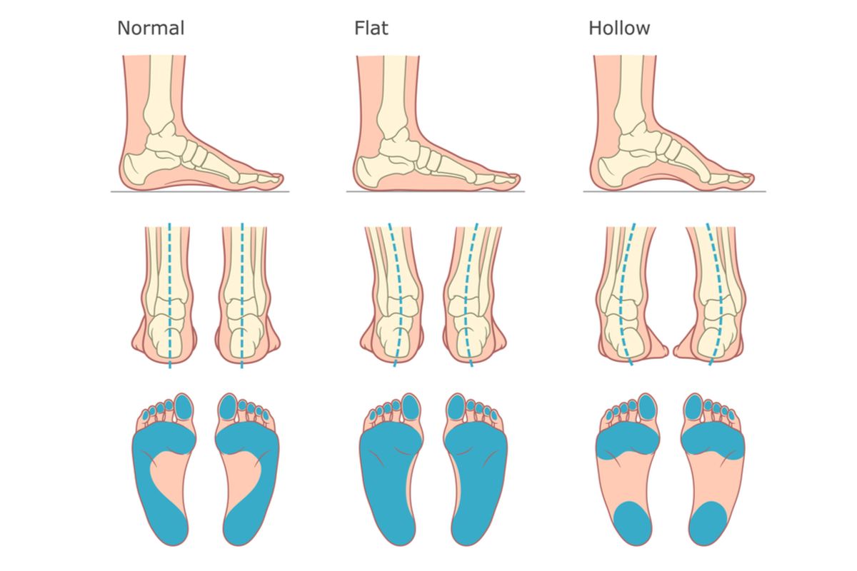 Penyakit Kaki Rata - Gejala, Penyebab, Pengobatan - Kompas.com