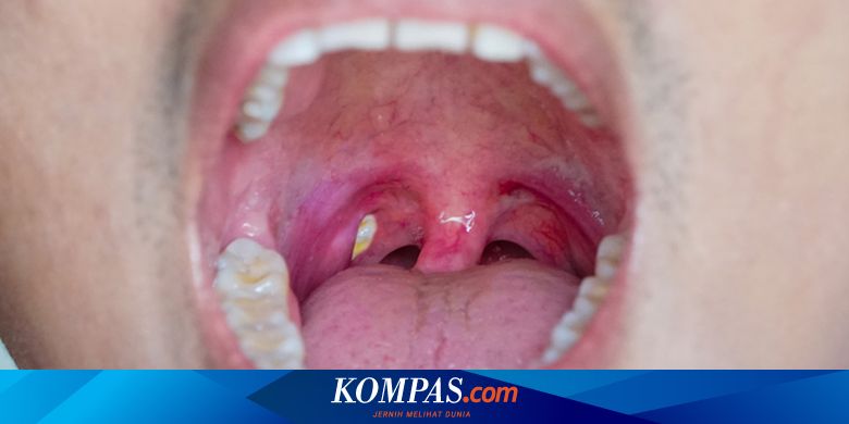 Apakah Munculnya Batu Amandel Berbahaya?