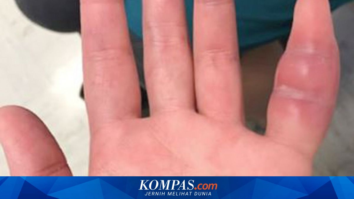 16 Penyebab Jari Tangan Bengkak dan Cara Mengatasinya