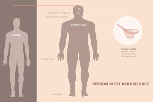 Berita Harian Akromegali Terbaru Hari Ini - Kompas.com
