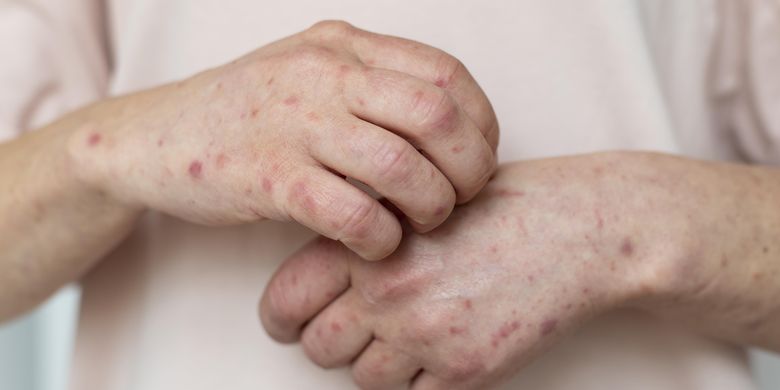 Rangkaian Cara Membunuh Kutu Scabies yang Ampuh untuk Mencegah ...