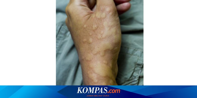 9 Cara Instan untuk Atasi Biduran yang Wajib Kamu Ketahui