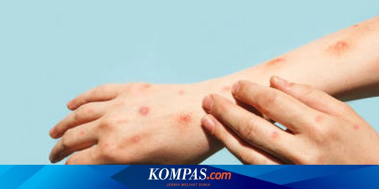 Berita Harian Perbedaan Campak Dan Cacar Air Terbaru Hari Ini - Kompas.com