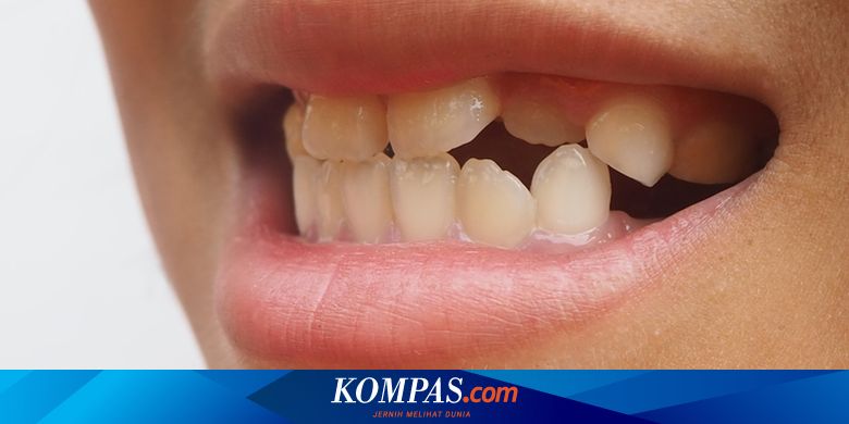 Apakah Gigi Tidak Rapi Bisa Diperbaiki?