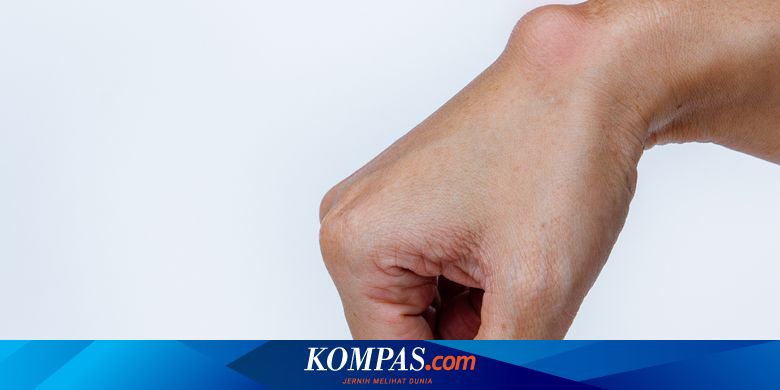 3 Cara Menyembuhkan Kista Ganglion, Tak Selalu Perlu Operasi