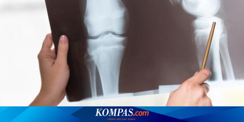 Dosen Unesa: Ini Penyebab, Gejala, dan Cara Pencegahan Osteoporosis