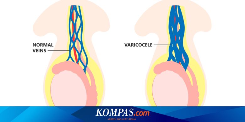 Penyakit Varikokel - Gejala, Penyebab, Pengobatan - Kompas.com