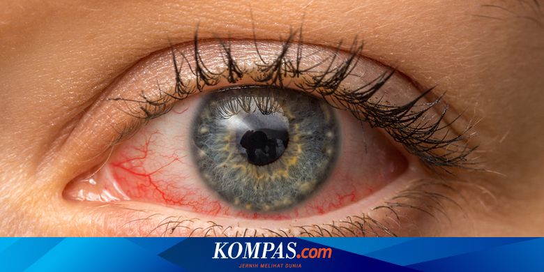 16 Cara Mengobati Mata Merah dan Berair