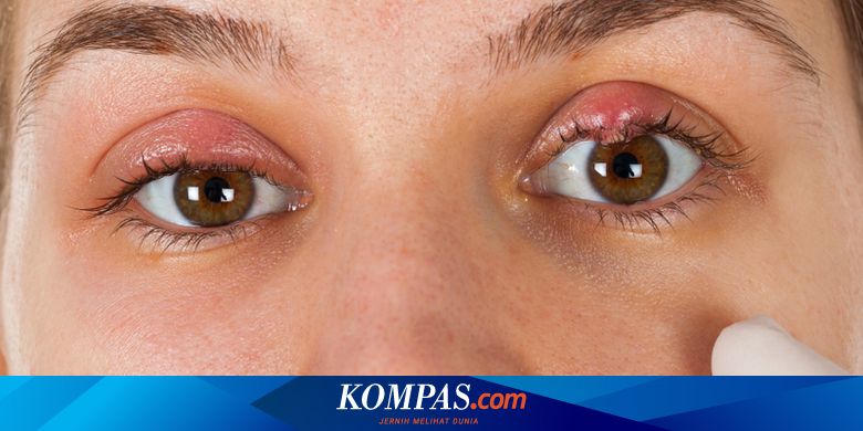 Kenali Apa Itu Bintitan di Kelopak Mata Luar, Gejala, dan Penyebabnya