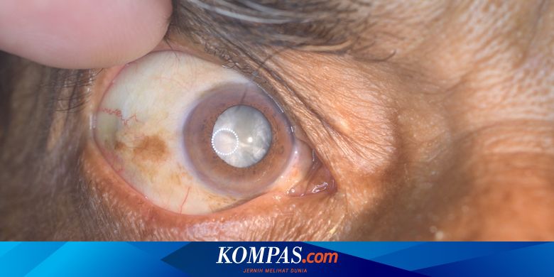 4 Gejala Katarak dan Cara Mengatasinya