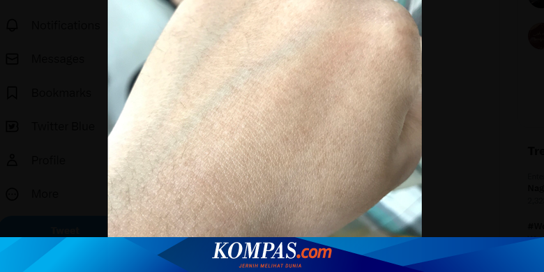 Viral, Foto Tangan Berkerut dan Flek Hitam, Apa yang Harus Dilakukan?