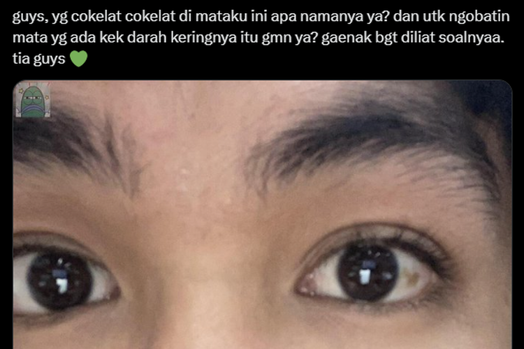 Muncul Bercak Kecoklatan pada Mata, Dokter Jelaskan Penyebab dan Risikonya