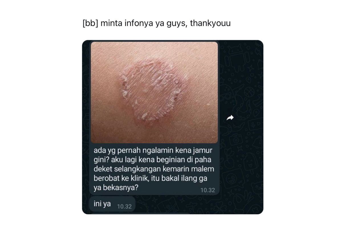 Apa Itu Ringworm pada Kulit? Begini Cara Pencegahan dan Pengobatannya