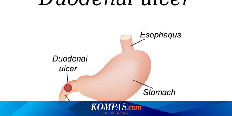 Penyakit Ulkus Duodenum - Gejala, Penyebab, Pengobatan - Kompas.com