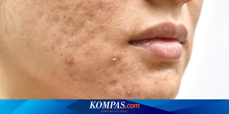 Berita Terkini Harian Apa Itu Bopeng Terbaru Hari Ini - Kompas.com