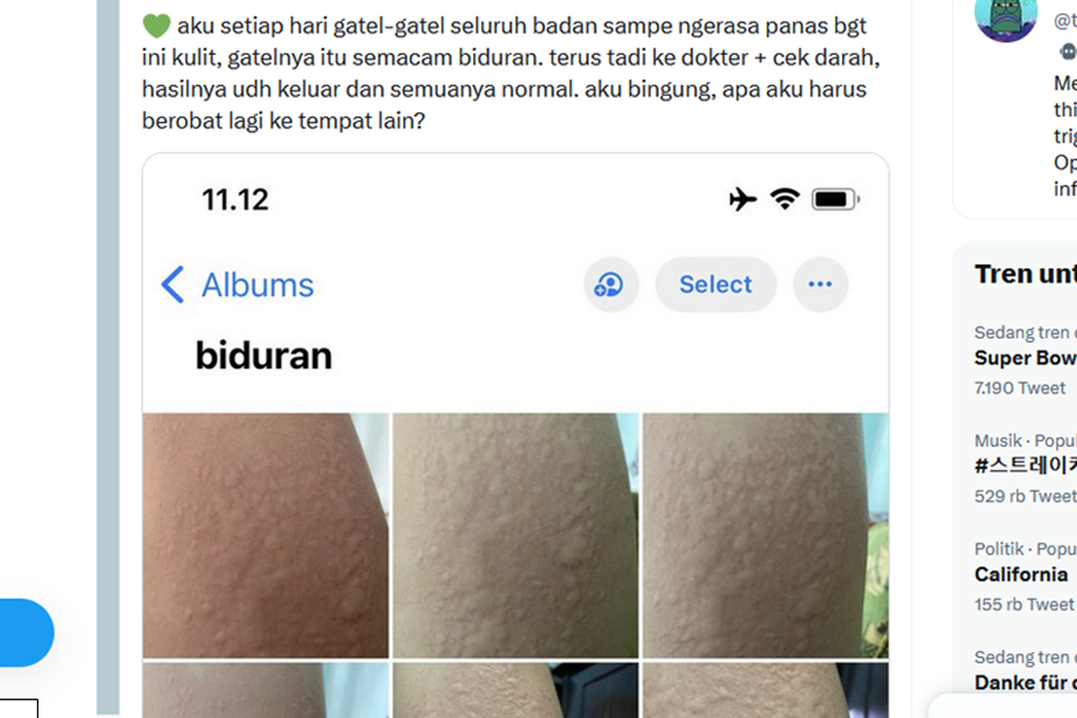 Ramai soal Kulit Badan Terasa Gatal dan Panas Mirip Biduran, Apa ...