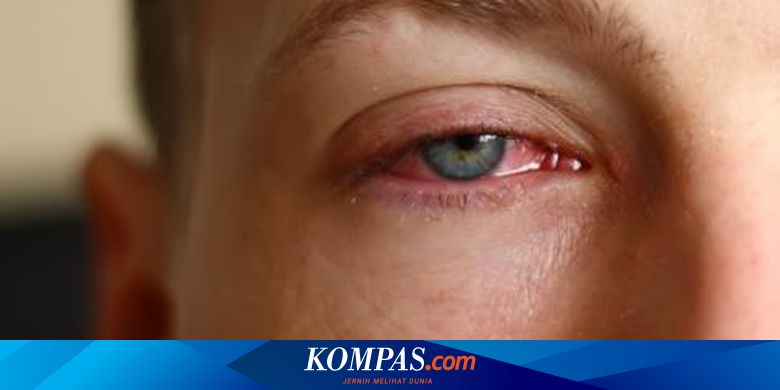 4 Penyebab Mata Merah dan Cara Menghilangkannya