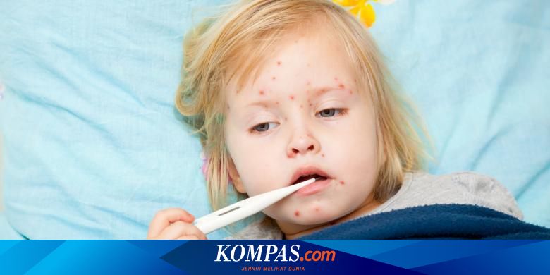 Kenali Gejala Campak dan Pencegahannya