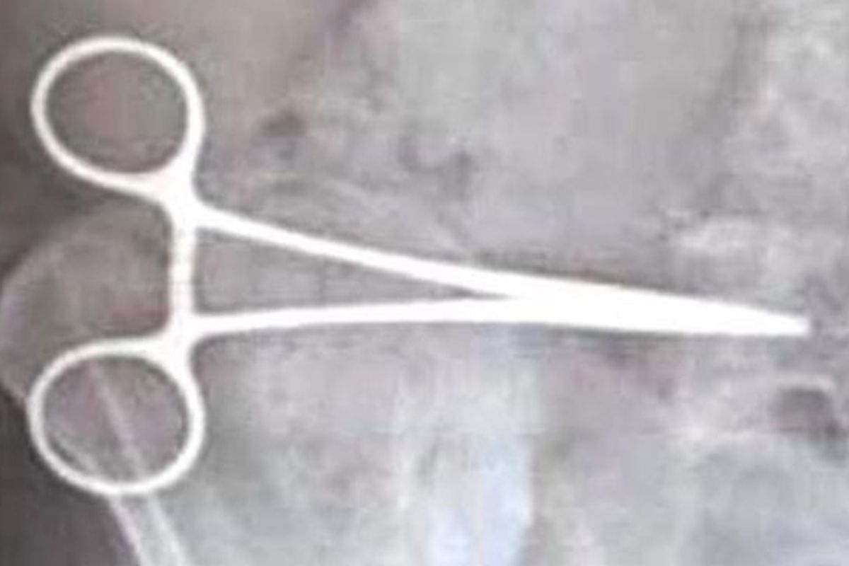 Gunting Bedah Tertinggal di Dalam Perut Seorang Wanita, Diketahui 12 ...