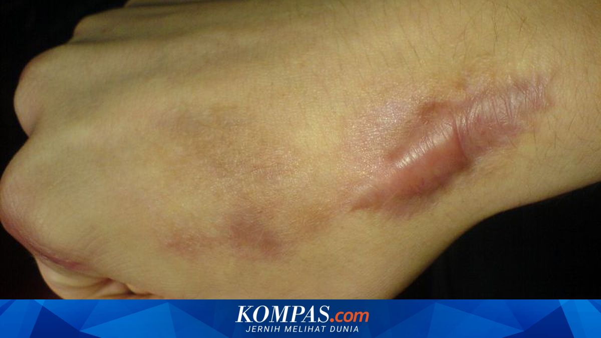 Penyakit Parut Hipertrofik - Gejala, Penyebab, Pengobatan - Kompas.com