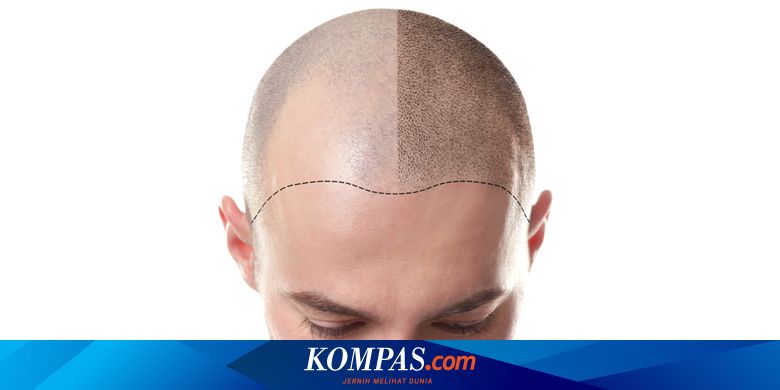 LG Ciptakan Helm Penumbuh Rambut untuk Atasi Kebotakan