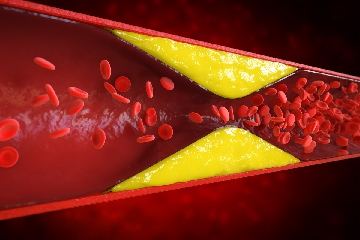 Mengenal Hypercholesterolemia: Kondisi yang Sering Diabaikan