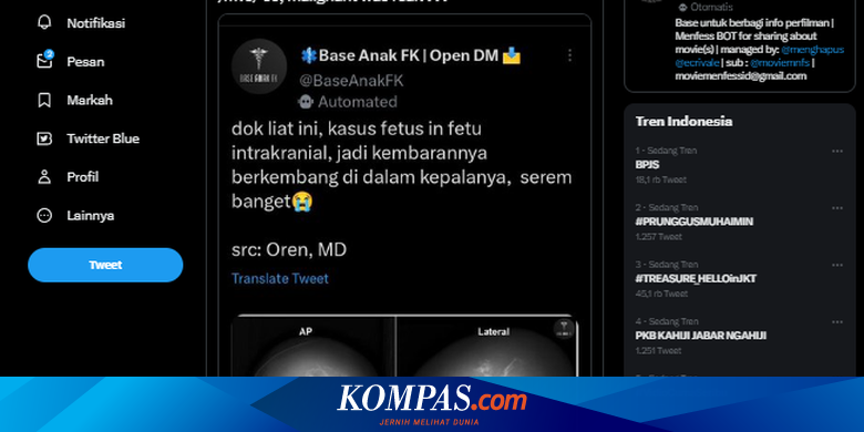 Apa Itu "Fetus in Fetu" yang Muncul di Film Malignant? Ini Penjelasan Dokter