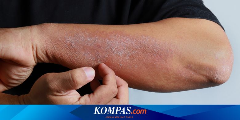 Penyakit Infeksi Kulit - Gejala, Penyebab, Pengobatan - Kompas.com
