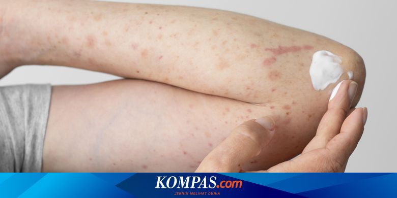 Mengenal Eksim, dari Gejala hingga Cara Mencegahnya