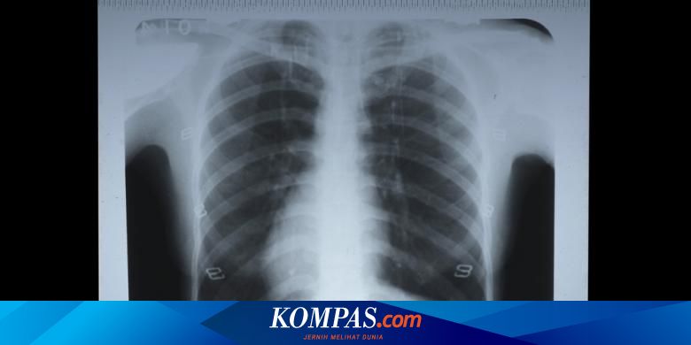 Anda Perokok? Rontgen Paru-paru Anda Sekarang!
