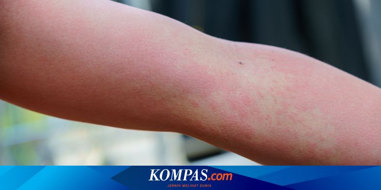 8 Jenis Biduran Berdasar Penyebabnya, Jangan Keliru