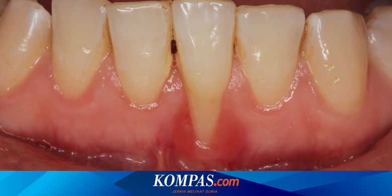 6 Jenis Penyakit Gusi, Perlu Diwaspadai